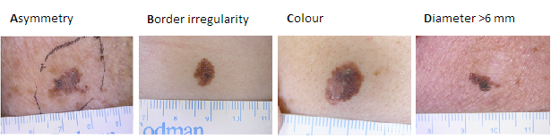 Detection and screening | National Cancer Prevention Policy Skin Cancer ...