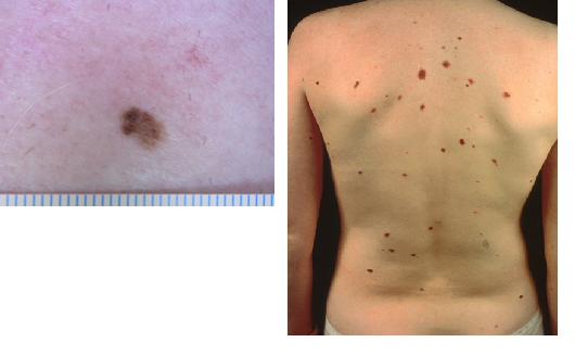 Risk factors/epidemiology | National Cancer Prevention Policy Skin ...